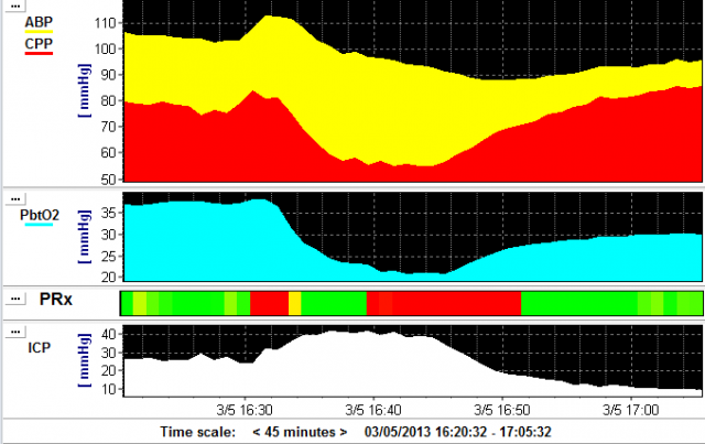 High resolution ICP data collection and analysis after severe TBI ...
